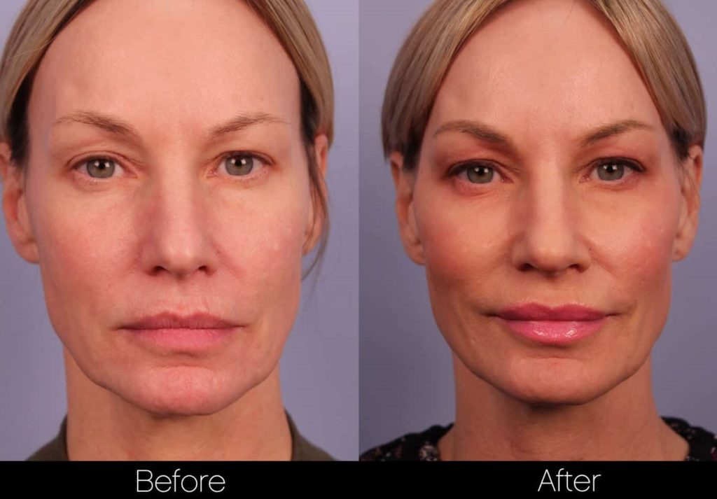 MORPHEUS8 – Vanity Medical Spa