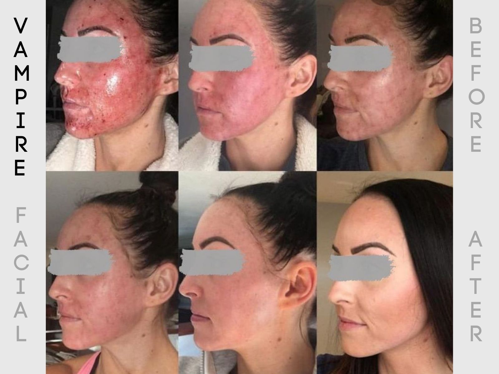 Vampire Facial: What Is It, Benefits & How Does It Help? | Vanity ...